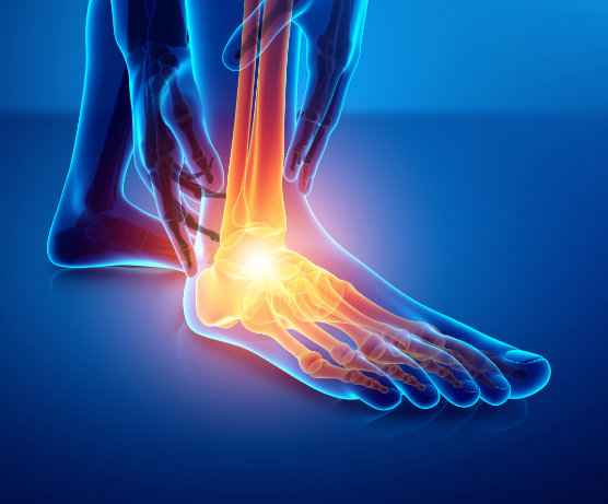 Tendinitis de pie | Corporación Fisiogestión